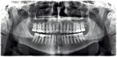 Ortopantomografía Dentisalut