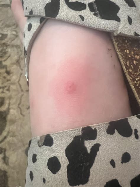 Unknown Bite R Spiderbites