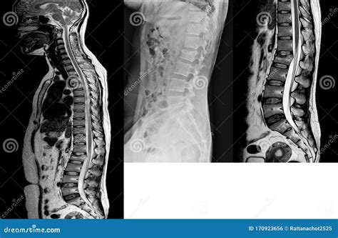 Compression Fracture Mri At Rhonda Freese Blog