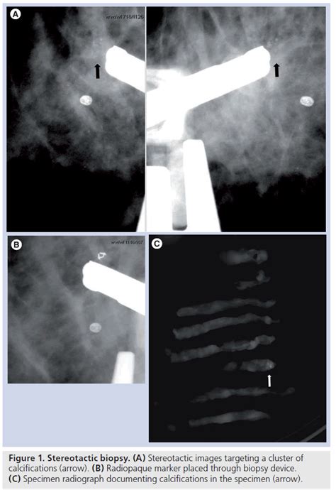 Image Guided Percutaneous Breast Biopsies