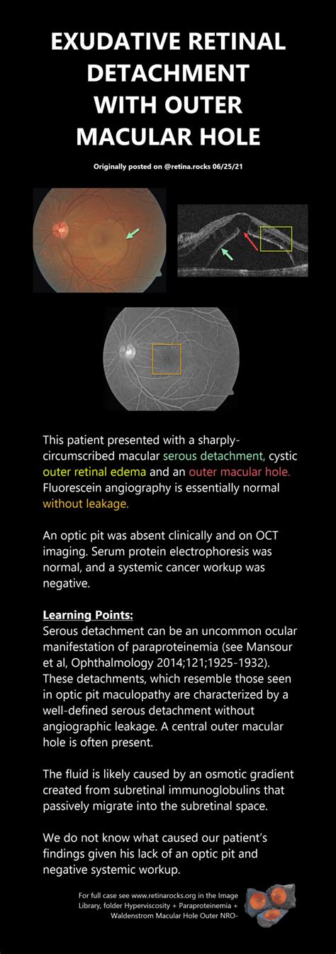 Serous Retinal Detachment Oct