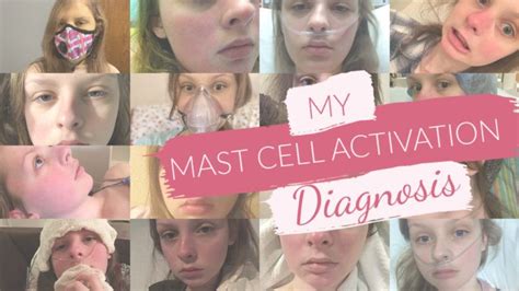 Mast Cell Activation Syndrome Artofit