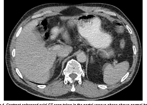 Figure 1 From Rare Brca2 Mutation And Msi H In Male Patient With