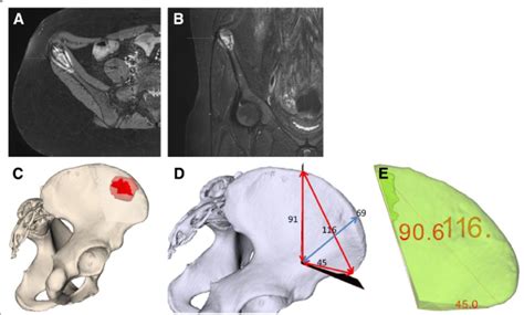 Case 1 Preoperative Planning Mri Of A Ewing Sarcoma Arrows At The