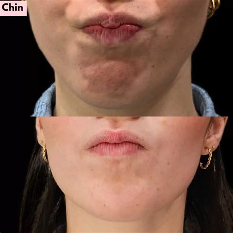 Cleft Chin Vs Smooth Chin How To Get Rid Of A Butt Chin 6 Best