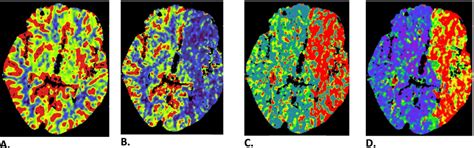 Postoperative Computed Tomography Perfusion Imaging Showing A Large