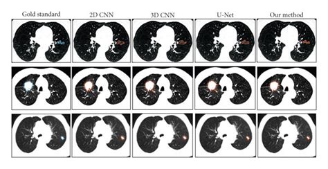 Subjective Evaluation Of Ct Image Segmentation Efficiency Of Different