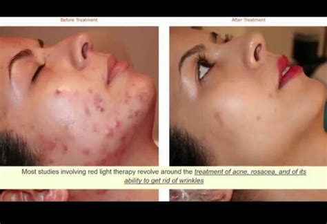 Michelle Perrone Francis Bsn Rn On Linkedin Red Light Therapy Is A