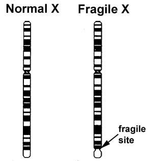 Fragile X Syndrome Crystalinks