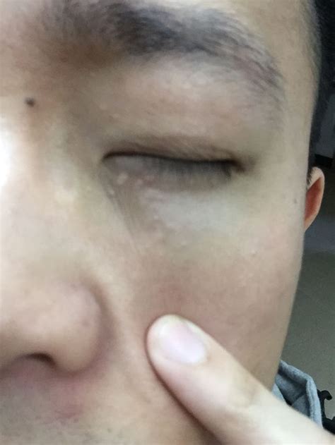 冬天汗管瘤图片 有来医生