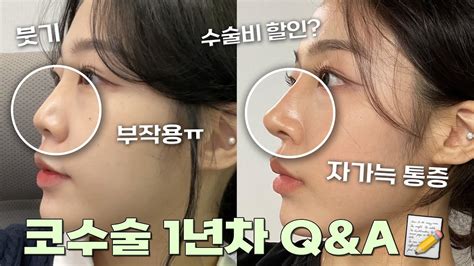 코수술 후기📝 당일부터 1년까지 나의 코수술 연대기 병원 고르는 법 비용 할인 통증 붓기 부작용 꼼꼼하게 정리해왔어요‼️ 복코 성형 코수술