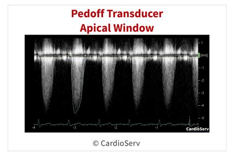 Helpful Tips To Mastering The Pedoff Probe Cardioserv