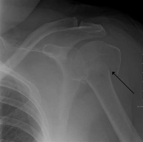 Proximal Humerus Fracture WikEM