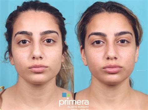 Botox® Cosmetic Before And After Pictures Case 743 Orlando Winter