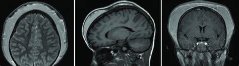 A Axial T2 Mri Brain Demonstrating Bilateral Subgaleal Fluid Download Scientific Diagram