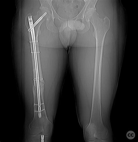 Closed Segmental Comminuted Femoral Fracture