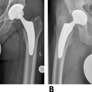Representative Pelvic X Rays Of The 7 Year Follow Up Exemplary For The Download Scientific