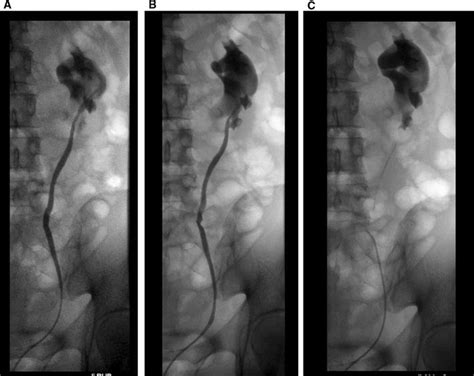 Retrograde Pyelography Of A Patient With Recurrent Ureteropelvic