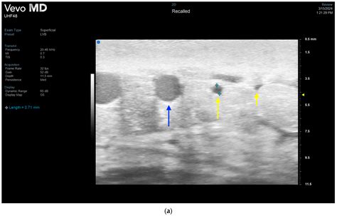 Ultrasound In Microsurgery Current Applications And New Frontiers