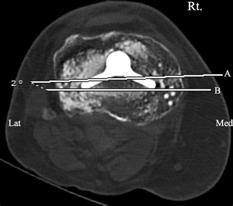Method 2 Tibial Component Rotation Is The Angle Between Tibial Download Scientific Diagram