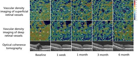 Figure 1 From Effect Of Conbercept Treatment On Macular Edema And Microvascular Structure In