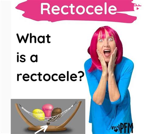 What Is A Rectocele