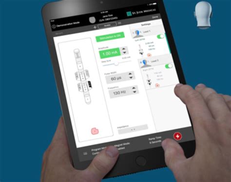 Directional Dbs System Targets Gpi To Relieve Parkinsons Symptoms