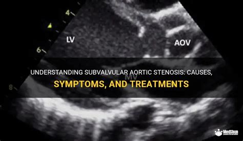 Understanding Subvalvular Aortic Stenosis Causes Symptoms And