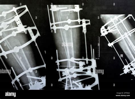 Distal Comminuted Fracture Fibula Managed By Plate And Screws Distal Tibia Managed By External