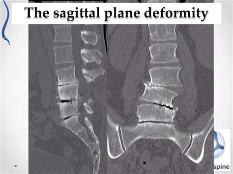 Importance Of The Sagittal Profile In Spinal Deformity Surgery Pptx