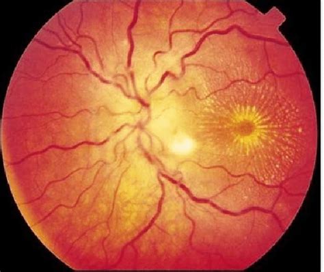 Optic Neuritis Due To Sarcoid Download Scientific Diagram