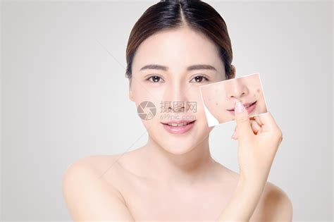 美白祛痘图片图片素材 正版创意图片500732844 摄图网