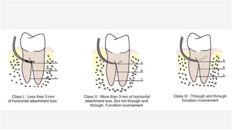 Furcation Involvement Periodontology 2pptx