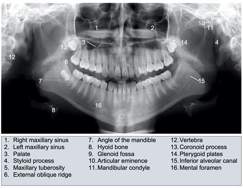 Mandibular Fracture X Ray