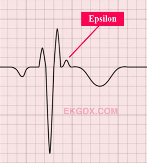 Epsilon Wave