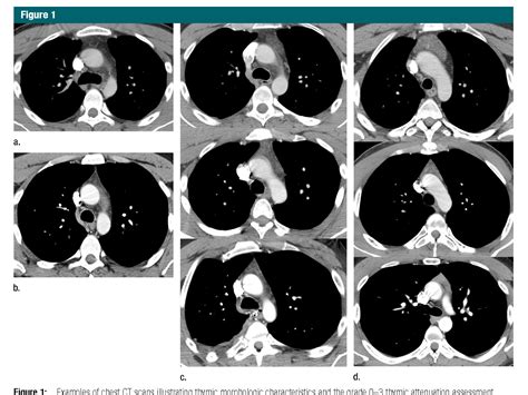 Figure 1 From Sex Difference In Normal Thymic Appearance In Adults 20 30 Years Of Age