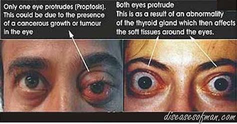 Exophthalmos Protrusion Of The Eyes Also Known As Exophthalmia Or Proptosis Causes
