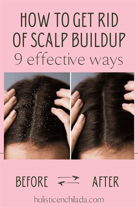 How To Get Rid Of Scabs On Scalp What It Is Causes And How To Treat