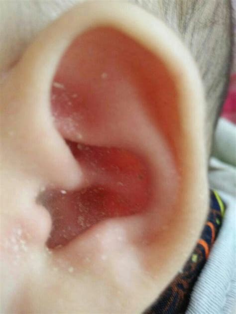 婴儿中耳炎初期图片 耳朵里有白色的脓图片 伤感说说吧