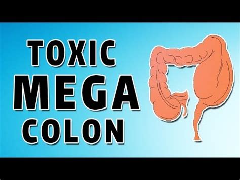Toxic Megacolon C Diff