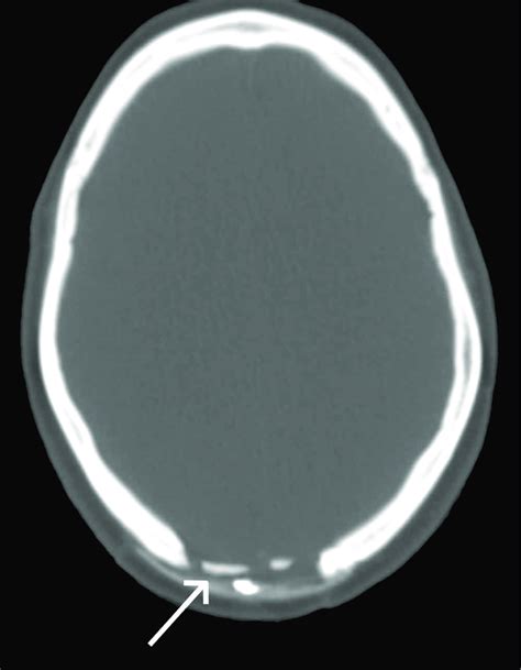 A Computed Tomography Of A Patient With An Occipital Bone Defect 23 Download Scientific