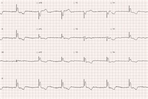 Coma In The Winter Body Temperature Is 27 Degree Celsius What Ecg