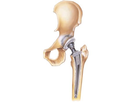 Hip Replacement Lawsuit What Hip Implant Lawyers Will Ask
