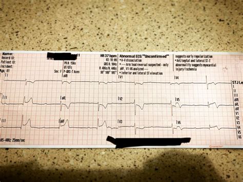Er Waited To Call The Stemi Rekgs