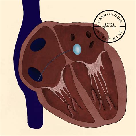 Nodo Sinusal El Marcapasos Natural Del Corazón 2026