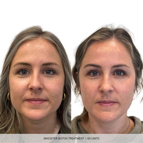 Specialty And Micro Botox Fargo Wellness District