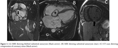 Journal Of Radiology A Case Report Of Calcified Submitral Aneurysm