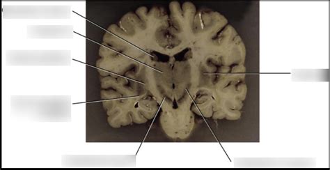 Basal Ganglia Coronal Section Diagram Quizlet