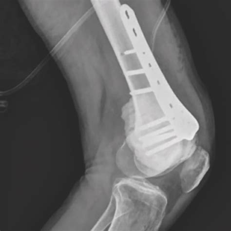 An Arthroscopic Approach For The Intralesional Curettage Of Giant Cell Tumor Of The Distal Femur