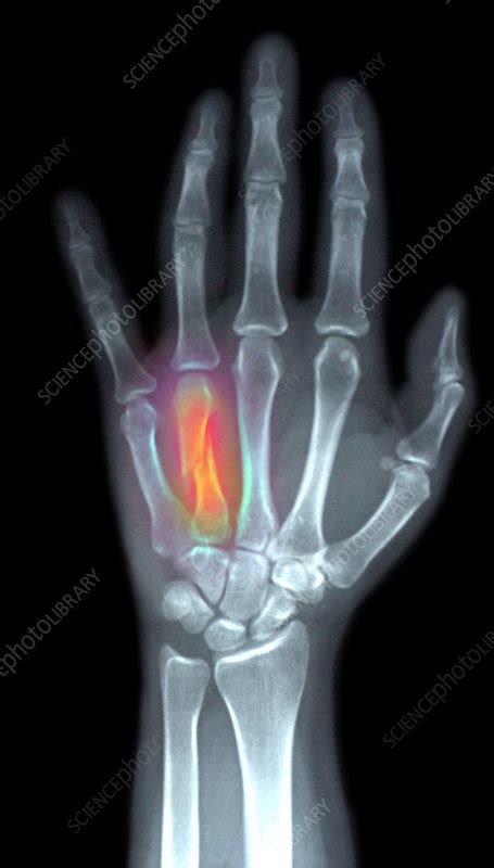 Fractured Metacarpal Stock Image M330 1269 Science Photo Library